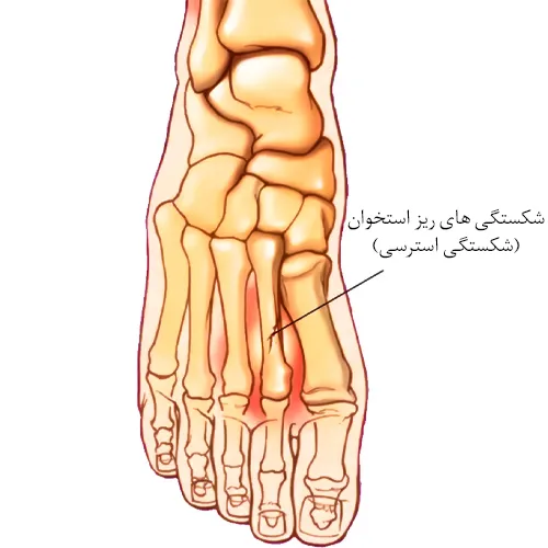چه عواملی باعث پا درد می‌شوند؟ بیماری ها و عارضه های مربوطه